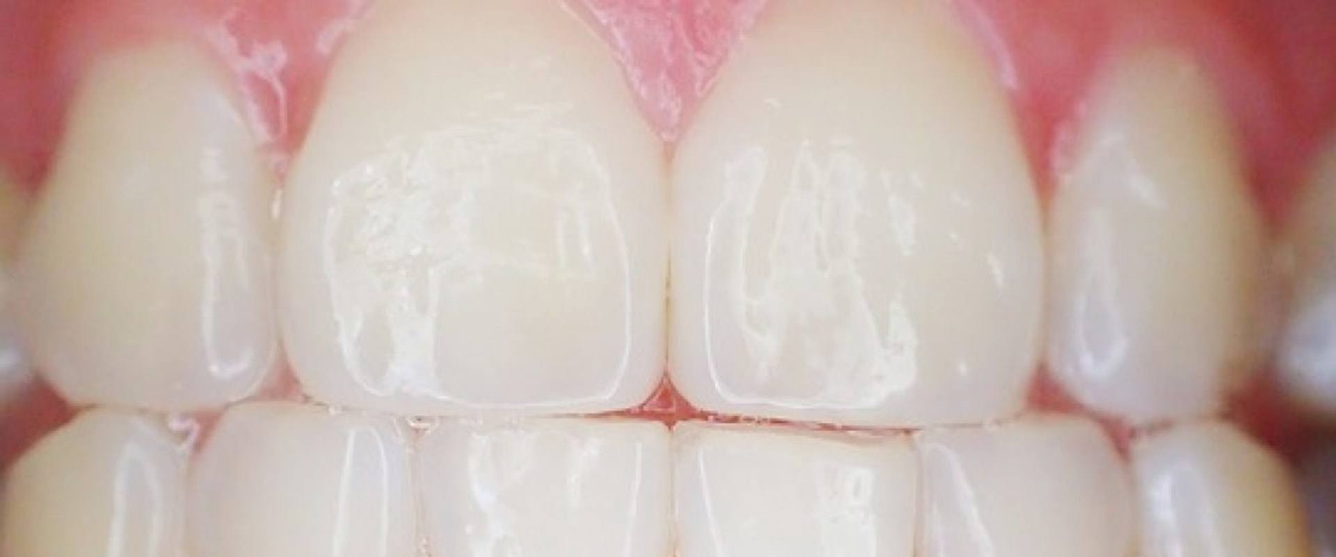 Are There Any Risks of Using Over-the-Counter Teeth Whitening Products?