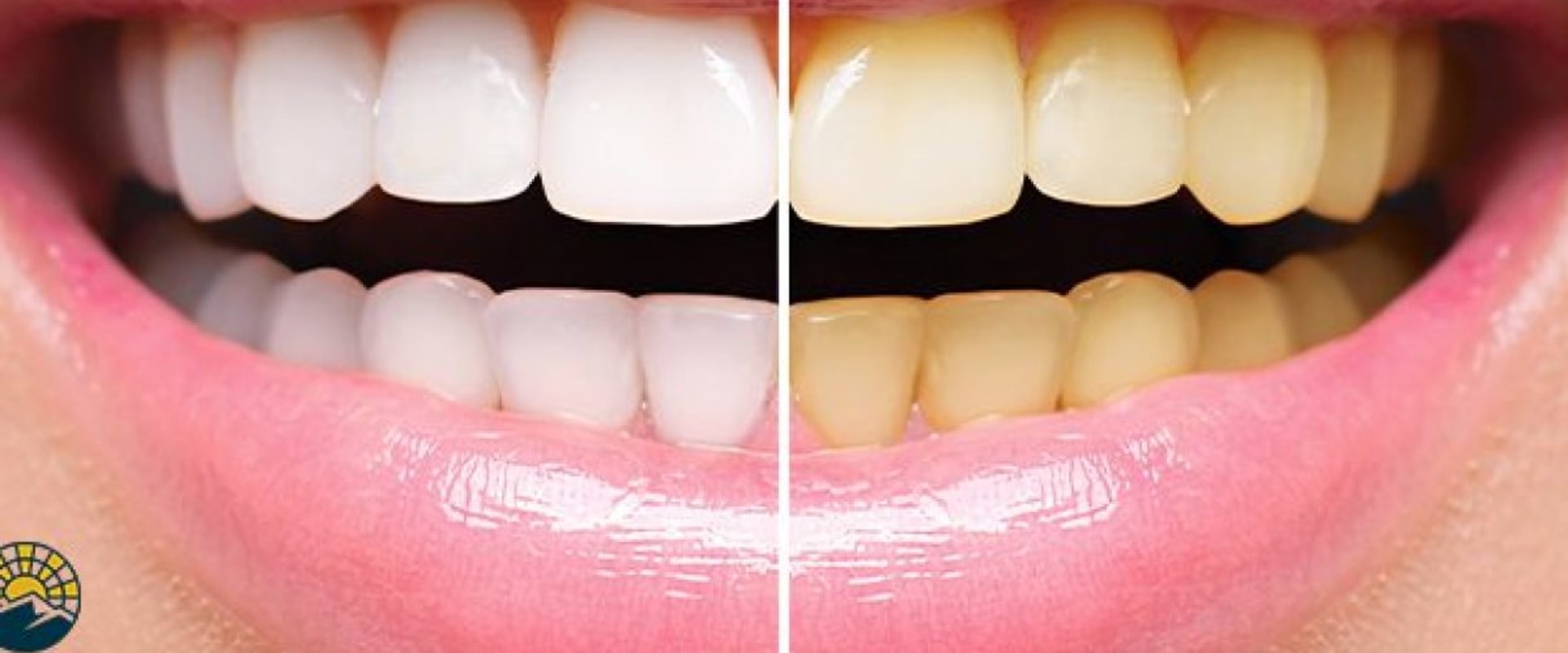 How Does Teeth Whitening Work? A Comprehensive Guide